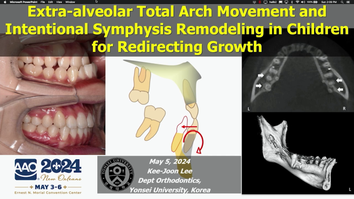 Extra-alveolar Total Arch Movement & Intentional Symphysis Remodeling ...