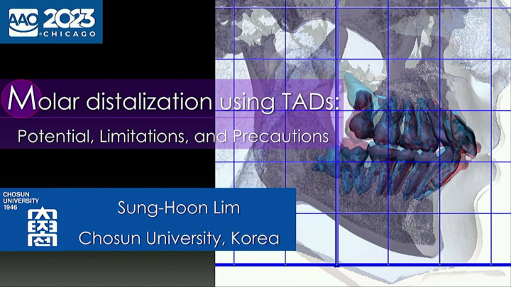 Molar Distalization using TADs: Potential, Limitations, and Precautions ...