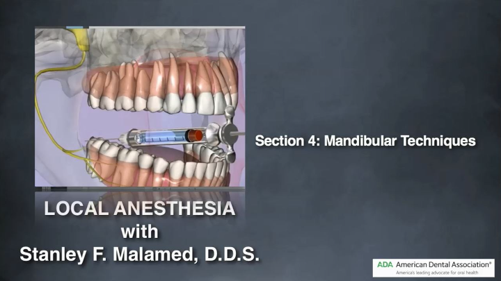 Local Anesthesia Part 4 & 5: Mandibular & Supplemental Techniques - American Dental Association