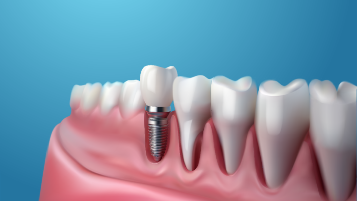 Implant Surgical Treatment Plan: Medical history considerations ...