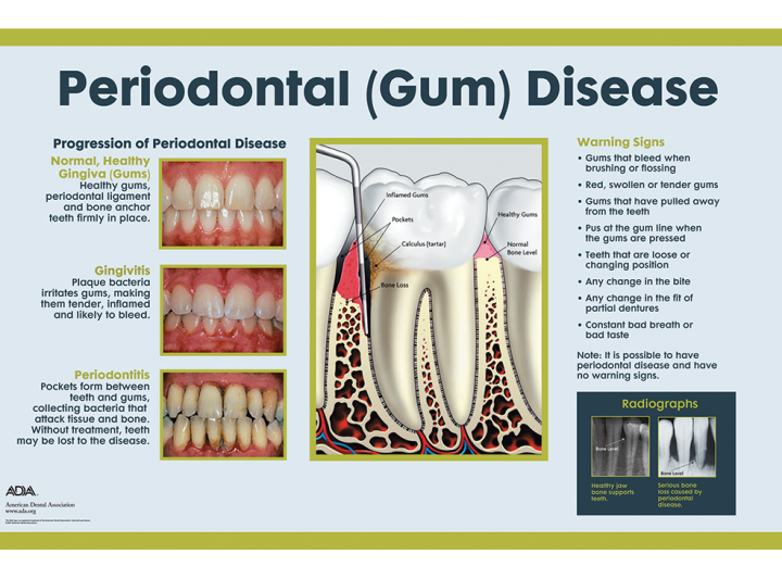 24" x 36" Unframed Wall Art, Periodontal Disease Chart - American ...