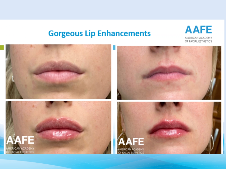 Dermal Filler Injectable Therapy for Every Dental Practice - American ...