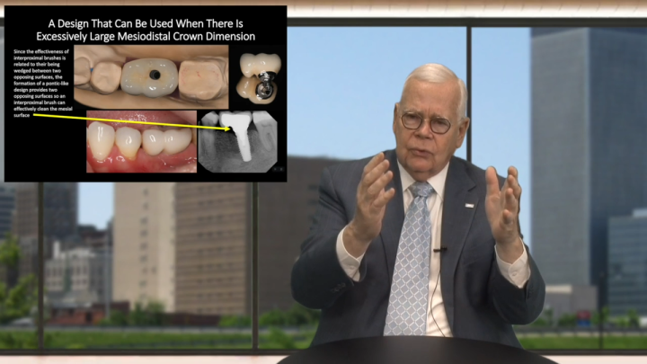 Part 2: Prosthetic-Related Complications with Single Implants and Their ...
