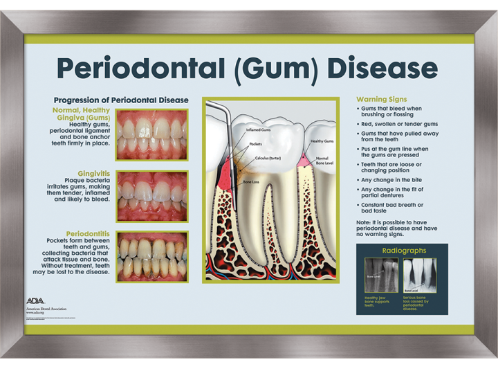 16" x 20" Framed Wall Art, Periodontal Disease Chart - American Dental ...