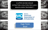 Is Upper Second Molar Extraction a Solution for Class II Malocclusion ...