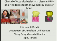 Clinical Effects of Platelet Rich Plasma on Alveolar Bone and ...