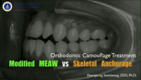 Orthodontic Camouflage Treatment: Modified MEAW vs Skeletal Anchorage ...