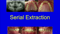 Serial Extraction: Beyond the Basics - American Association of ...