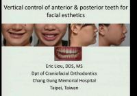 Vertical Control of Anterior and Posterior Teeth for Facial Esthetics ...