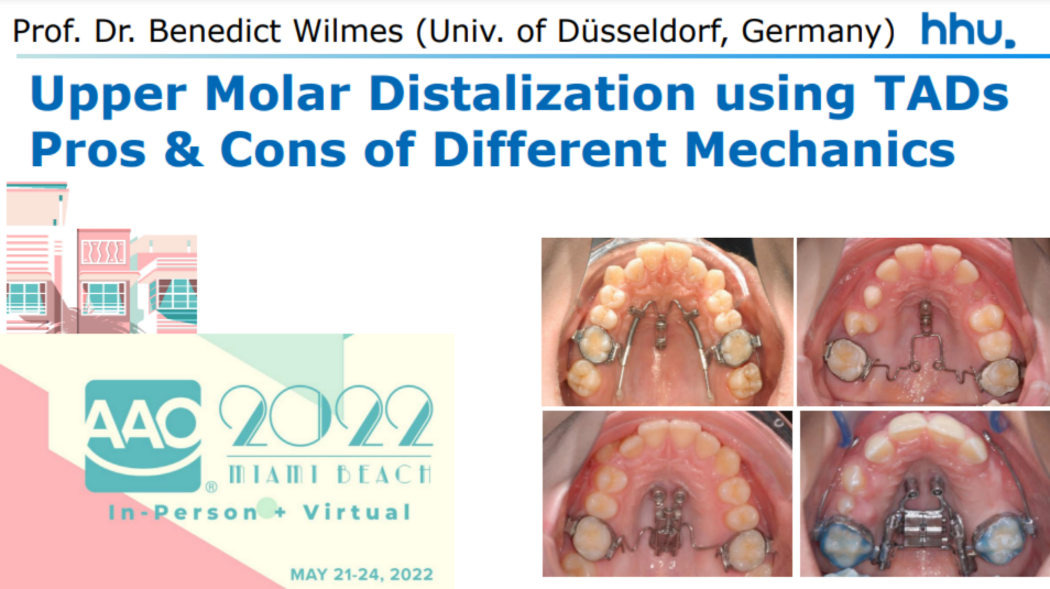 Upper Molar Distalization using TADs: Pros & Cons of Different ...