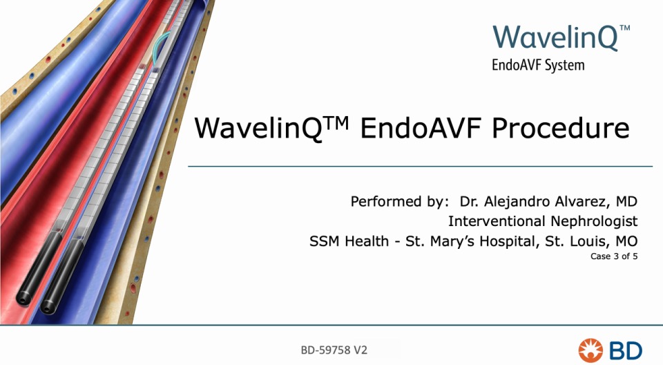 WavelinQ EndoAVF Procedure - BD Peripheral Intervention